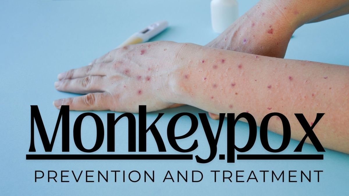 Monkeypox: Comprehensive Guide on Prevention, Treatment, and Social ...